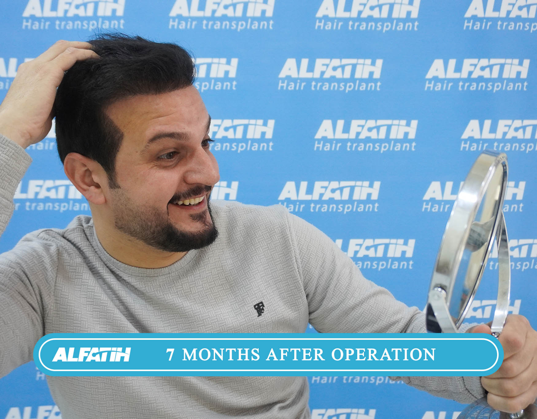7 Months after Operation - Alfatih Hair Transplant