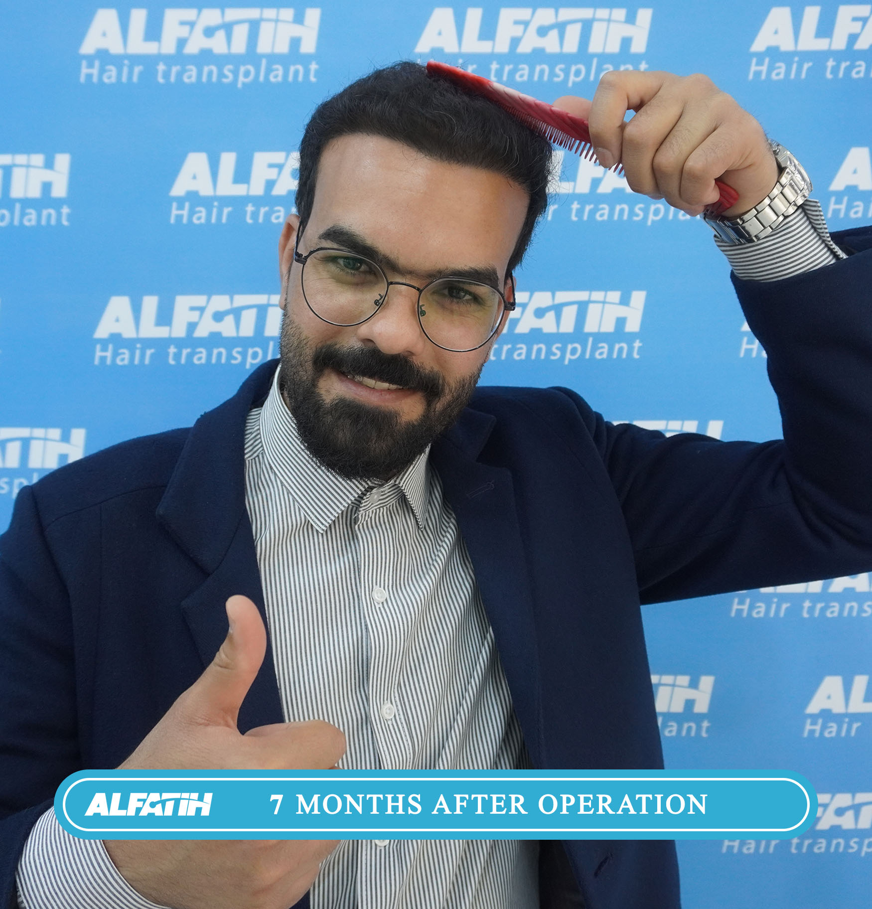 7 Months after Operation - Alfatih Hair Transplant