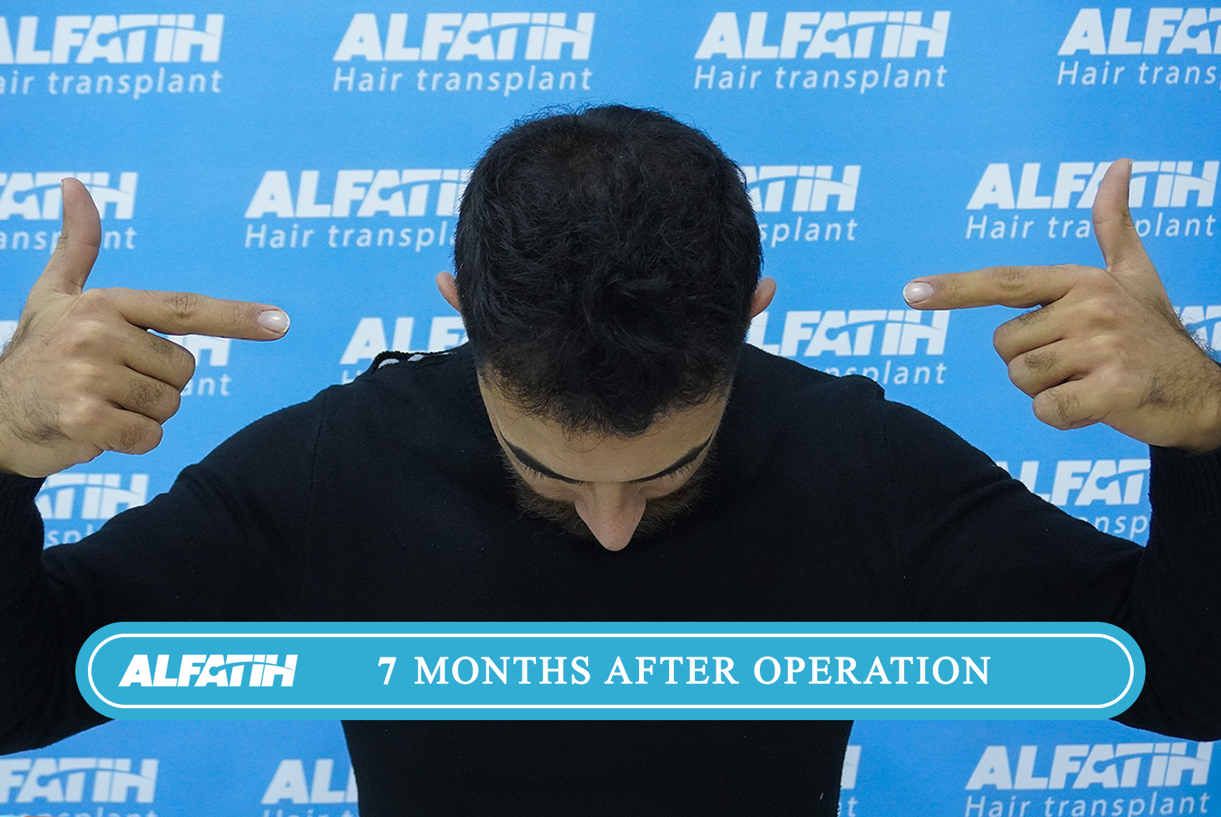 7 Months after Operation - Alfatih Hair Transplant
