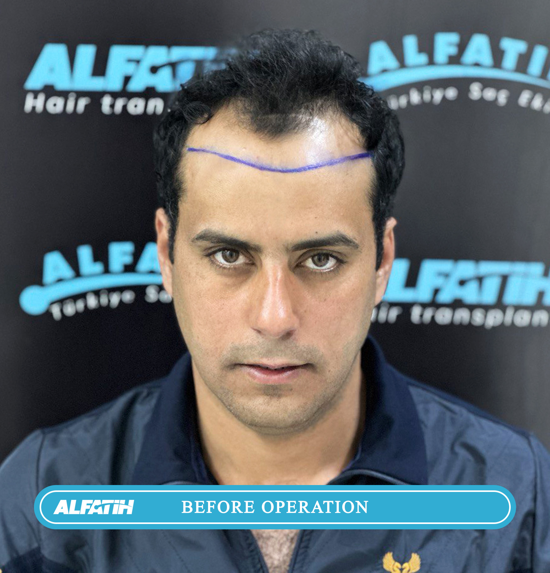7 Months after Operation - Alfatih Hair Transplant